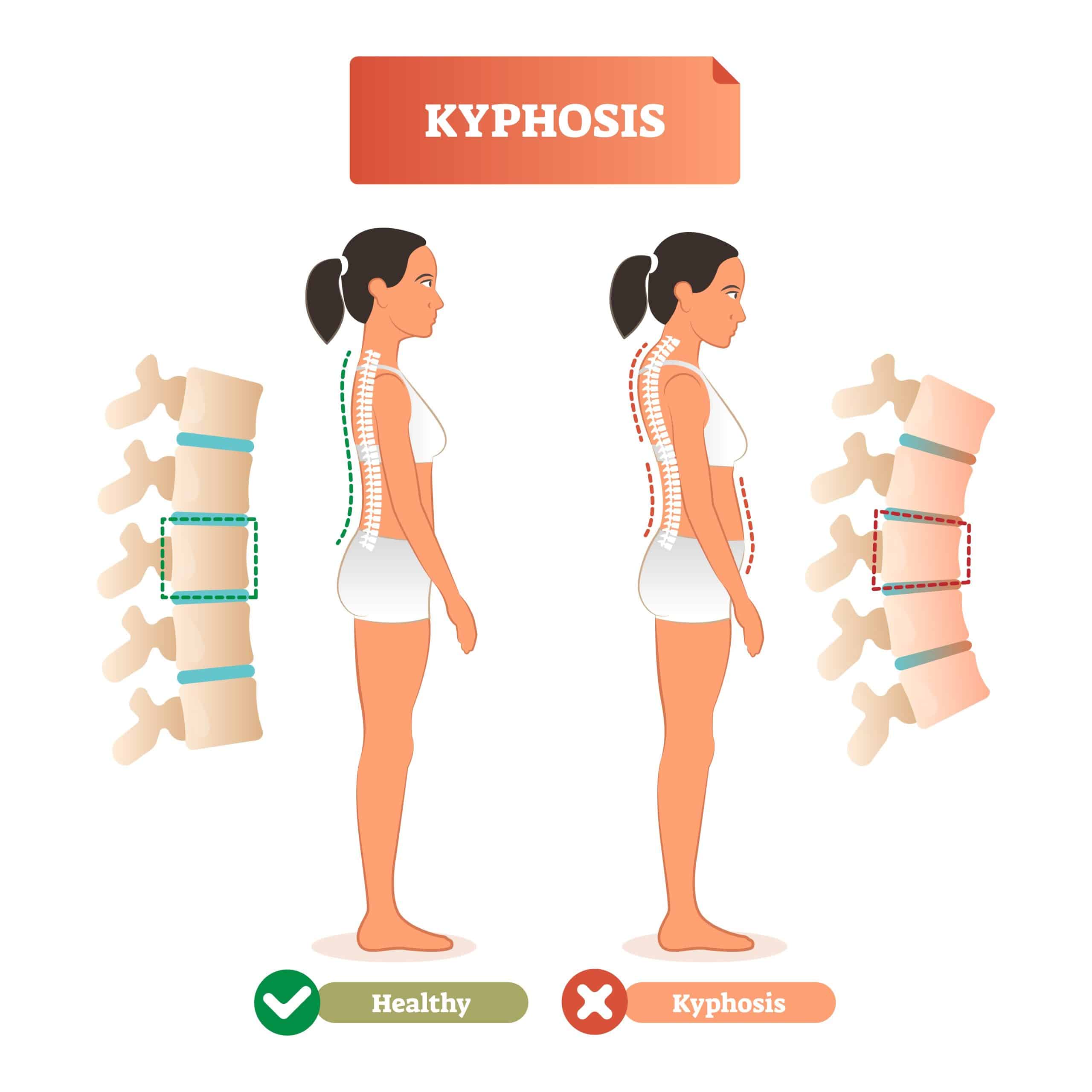 Why You Might Be A Good Candidate For Kyphoplasty | Birmingham, AL